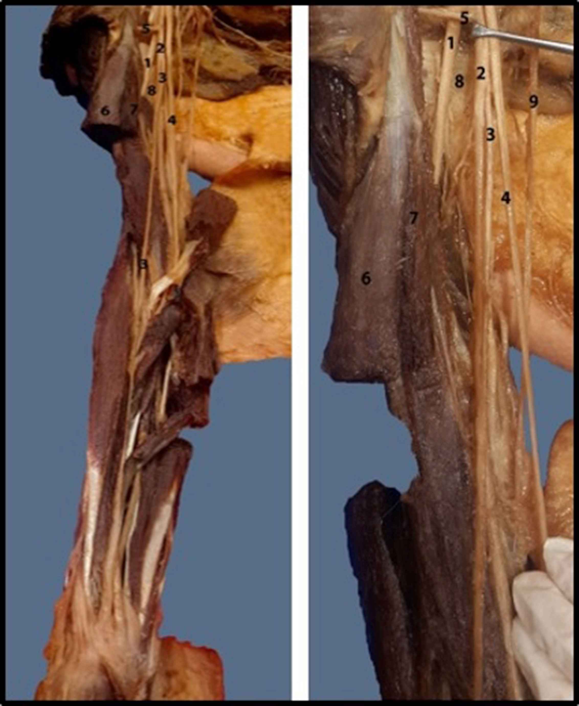 Axillary Fossa